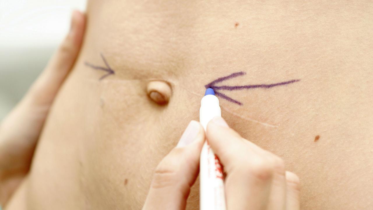 Nabelbruch: Risiken, Symptome, und Therapie bei Erwachsenen