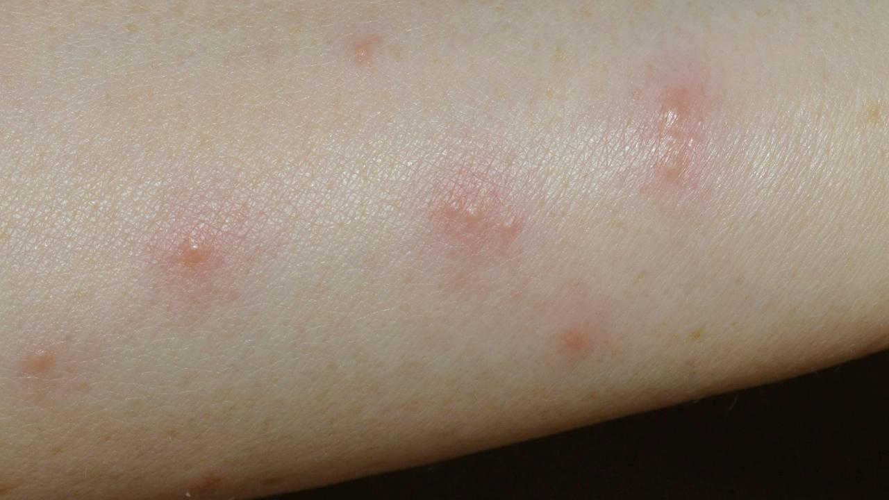 Grasmilben-Bisse: Milbenbisse erkennen und Juckreiz behandeln