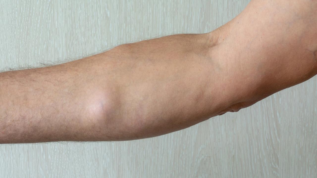 Lipom: Gutartige Fettgeschwulst oder bösartiger Tumor?