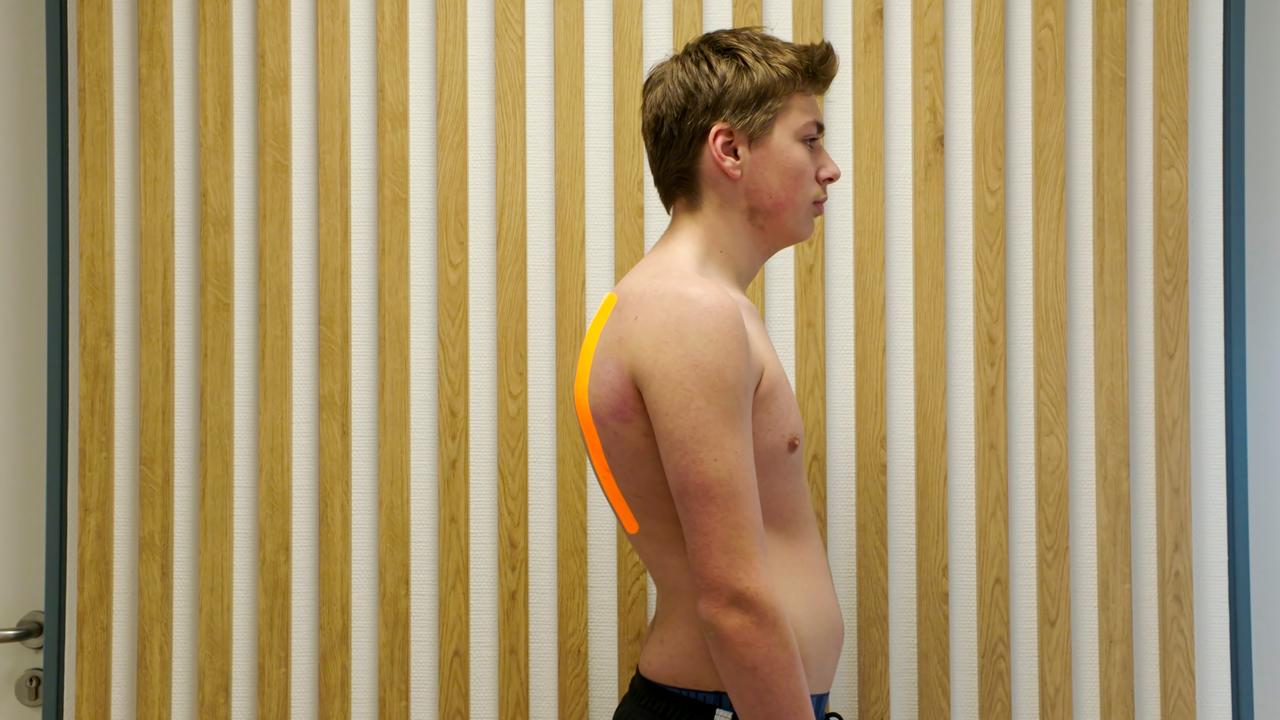 Morbus Scheuermann: Spätfolgen mit früher Therapie vermeiden